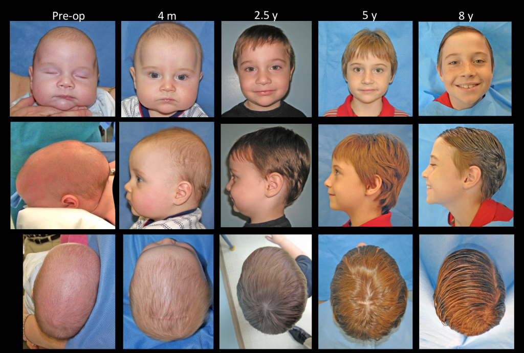 Before and After | Craniosynostosis