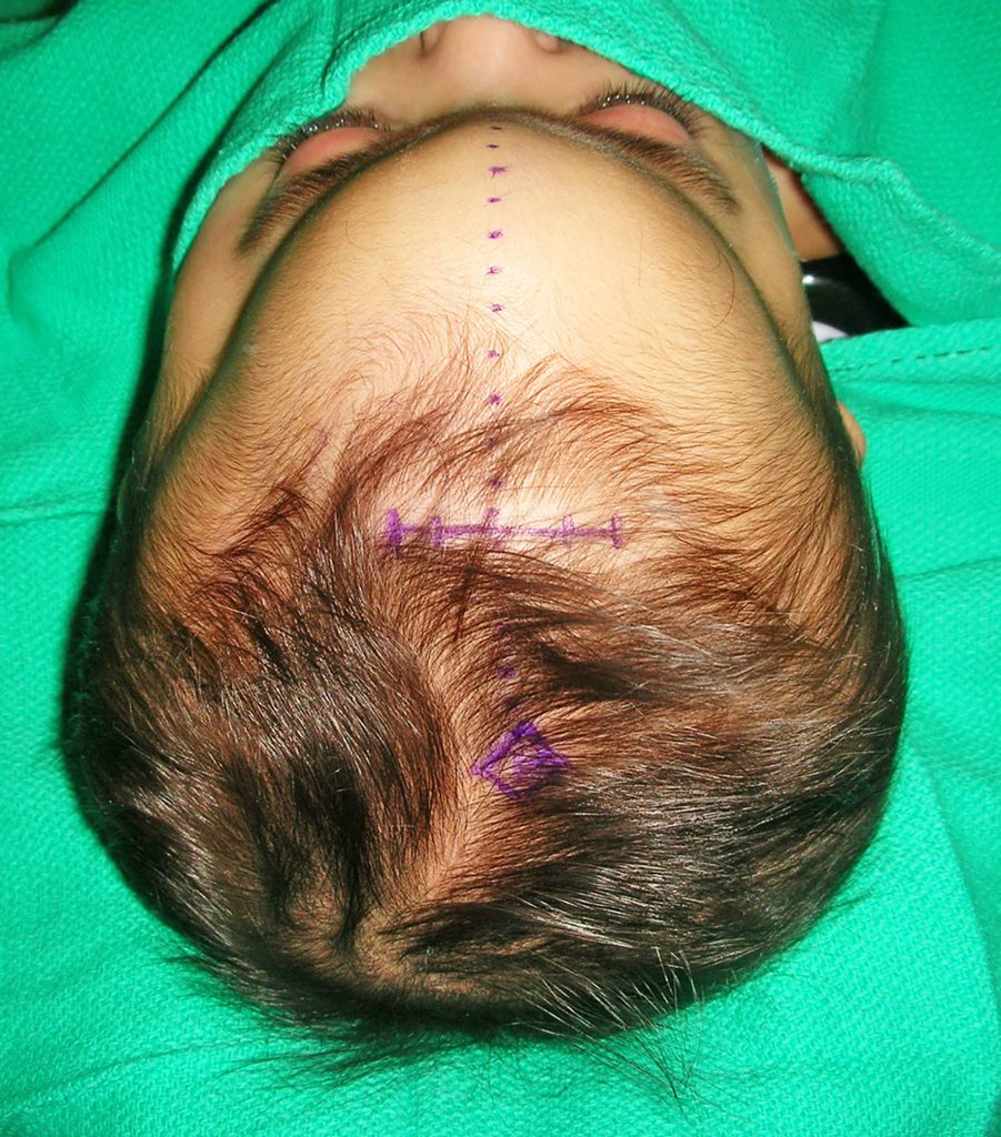 Metopic Synostosis Facts and Photos | Craniosynostosis