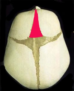 Metopic Synostosis Facts and Photos | Craniosynostosis
