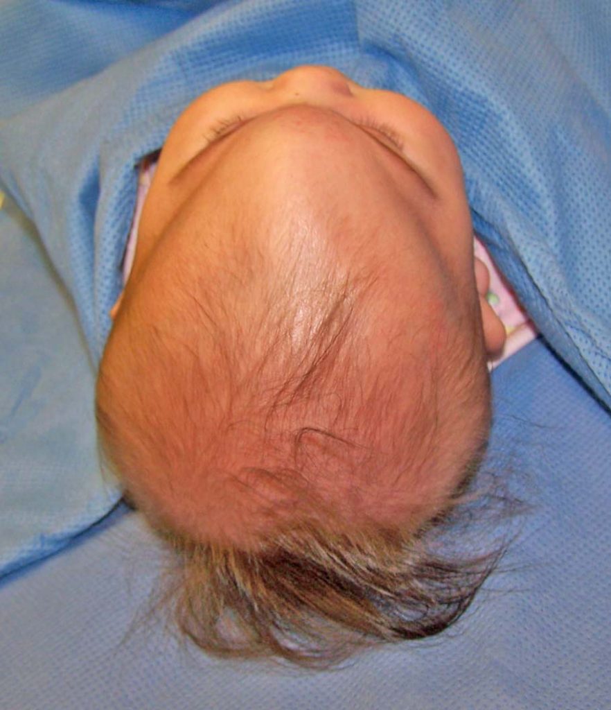 Metopic Synostosis Facts and Photos | Craniosynostosis