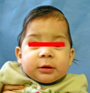 Sagittal Synostosis Facts and Photos | Craniosynostosis