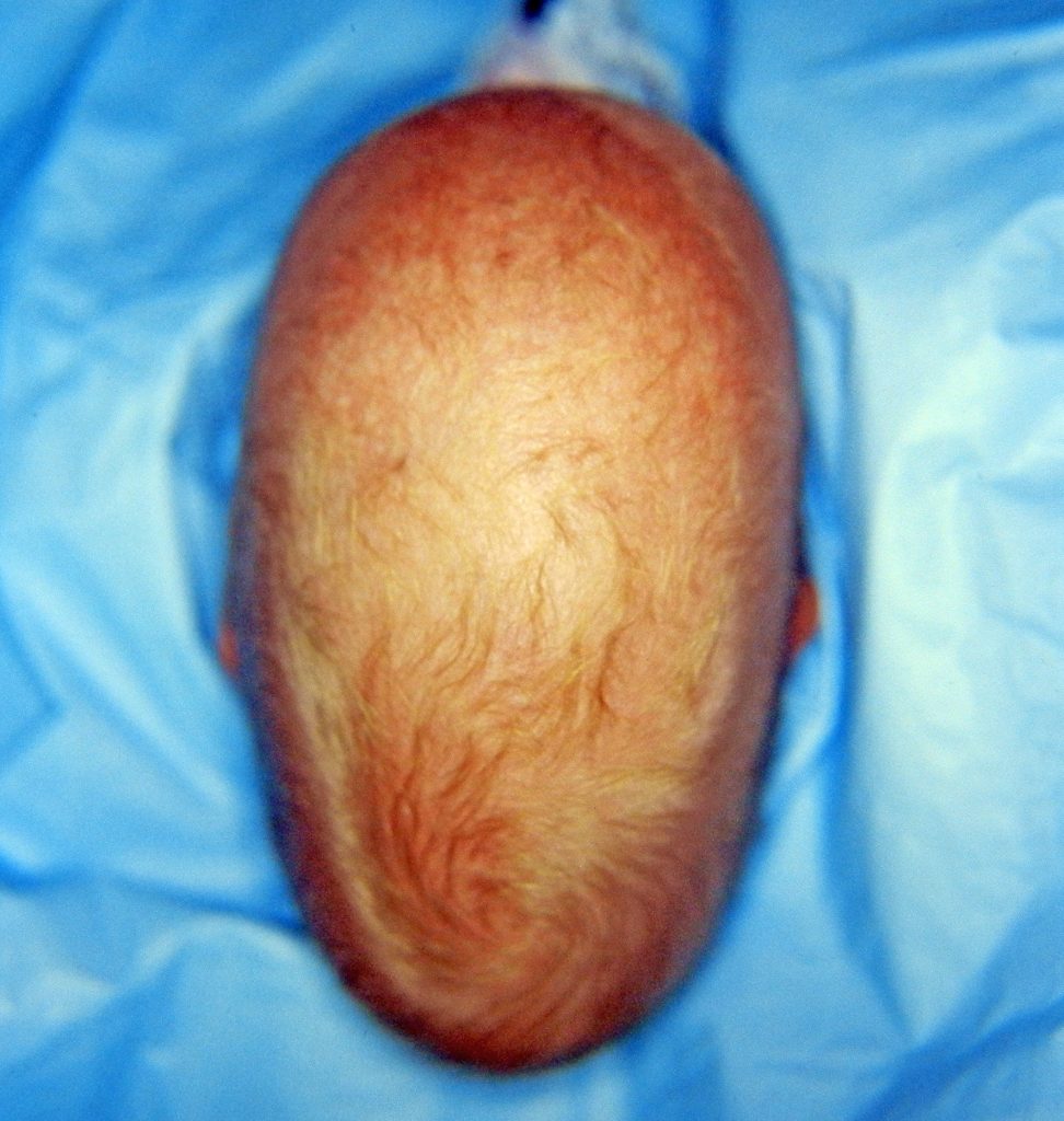 Sagittal Synostosis Facts and Photos | Craniosynostosis