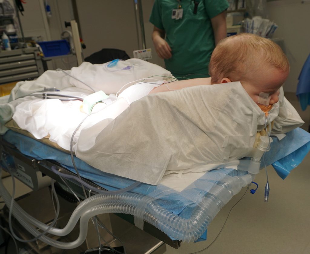 Sagittal Synostosis Facts and Photos | Craniosynostosis