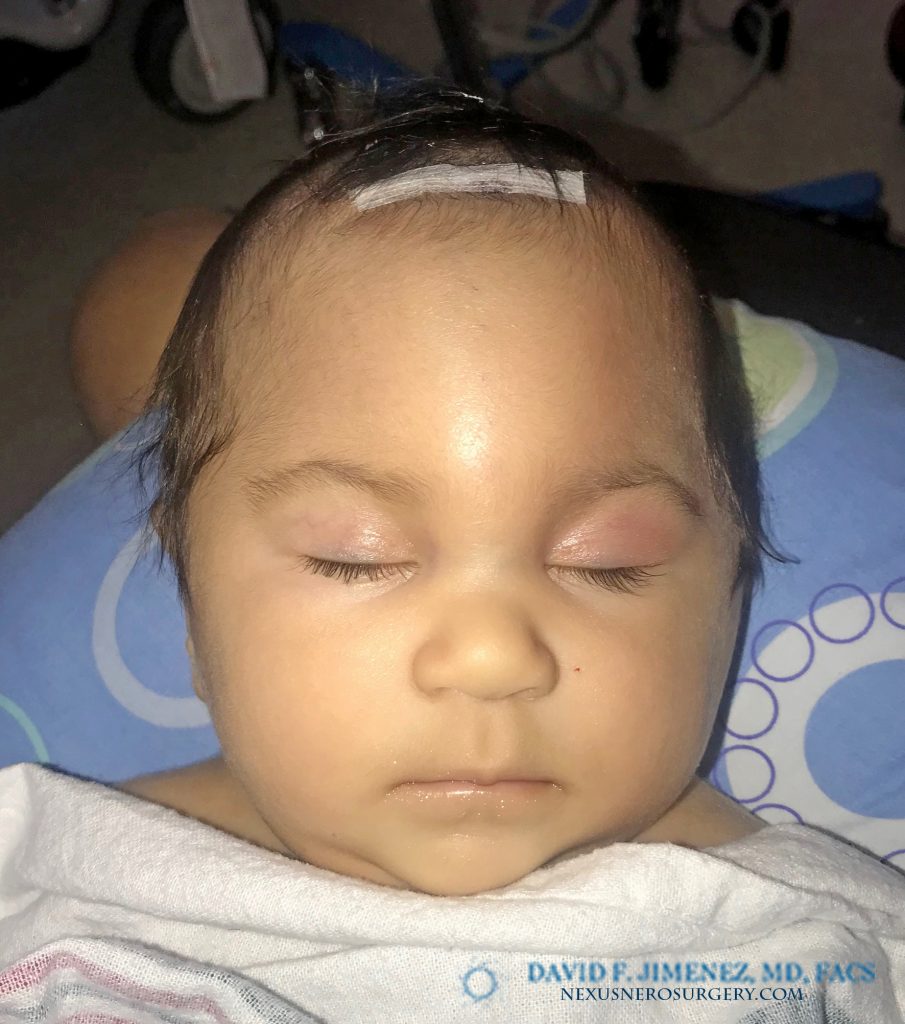 Metopic Synostosis Facts and Photos | Craniosynostosis