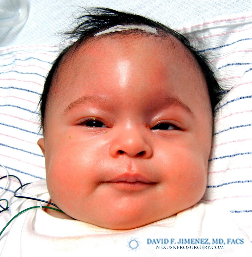 Metopic Synostosis Facts and Photos | Craniosynostosis
