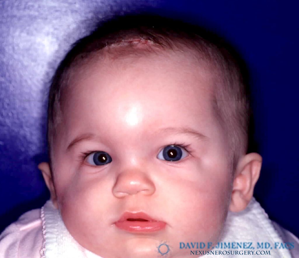 Metopic Synostosis Facts and Photos | Craniosynostosis