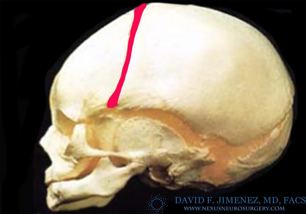 Bicoronal | David F. Jimenez, MD