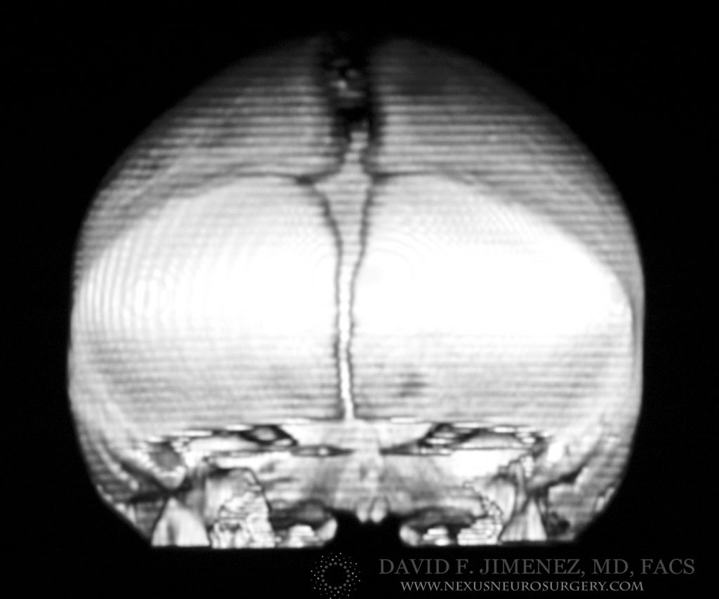 Bicoronal | Craniosynostosis