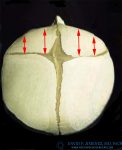 Bicoronal | Craniosynostosis