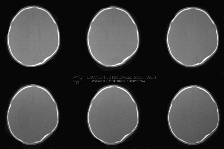 Lambdoid Synostosis Facts and Photos | Craniosynostosis