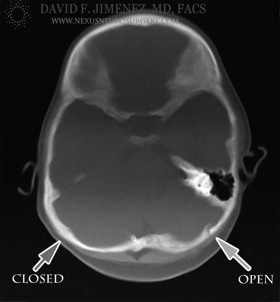 Lambdoid Synostosis Facts and Photos | Craniosynostosis