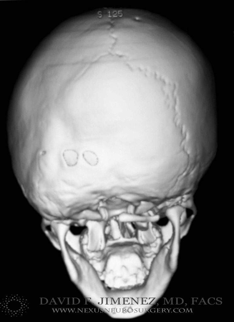 Lambdoid Synostosis Facts and Photos | Craniosynostosis