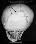 Lambdoid Synostosis Facts and Photos | Craniosynostosis