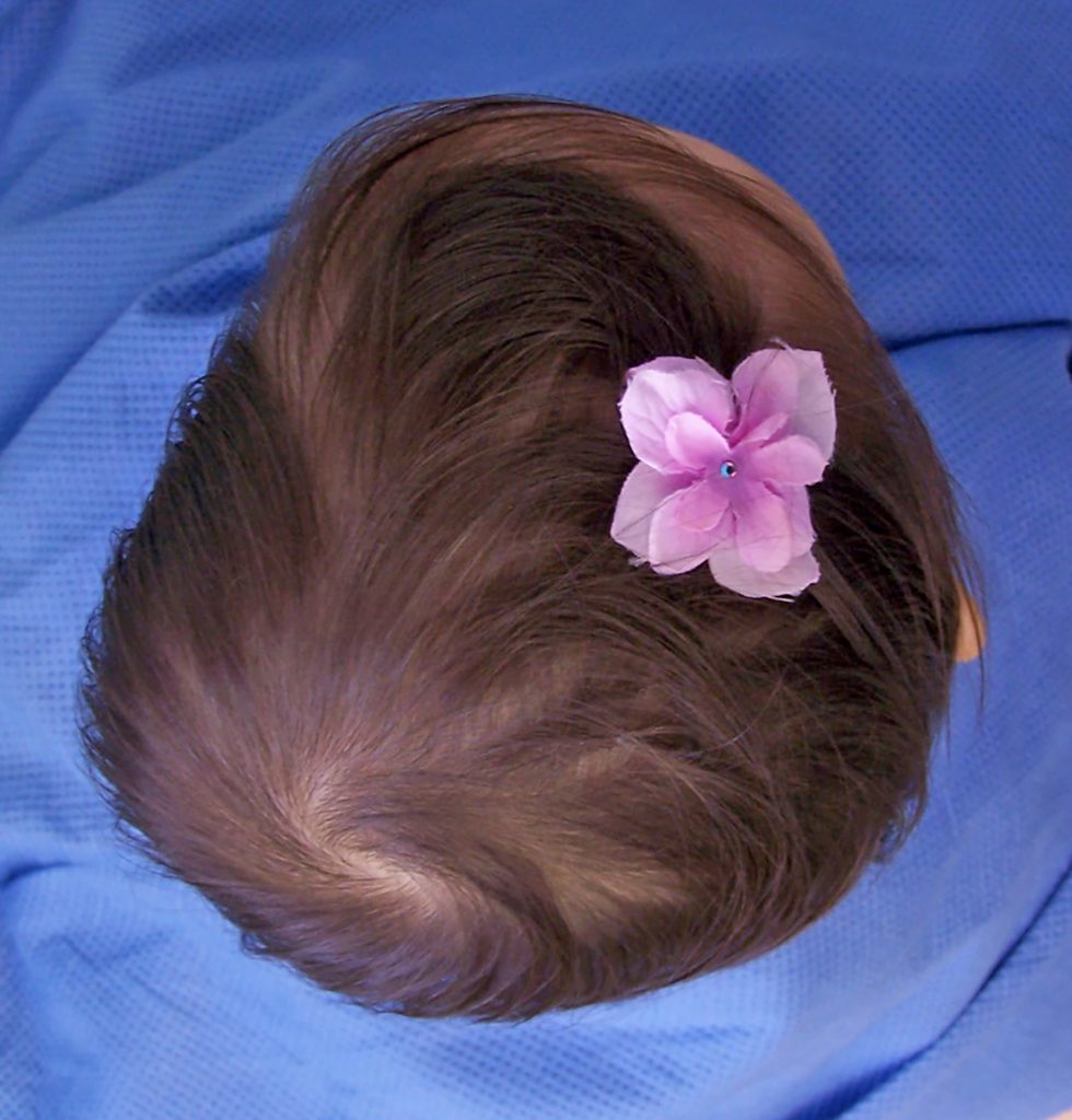 Lambdoid Synostosis Facts and Photos | Craniosynostosis