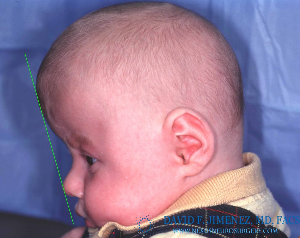 Bicoronal | Craniosynostosis