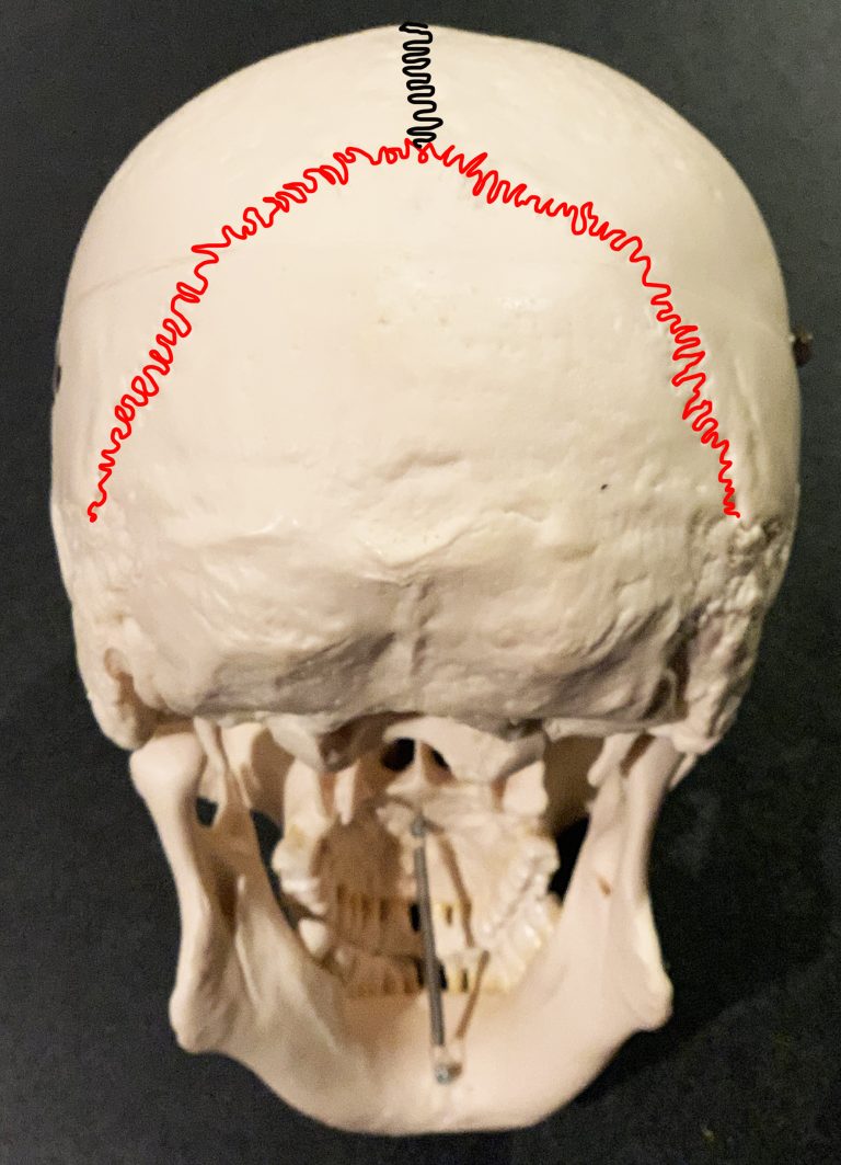 Lambdoid Synostosis Facts and Photos | Craniosynostosis