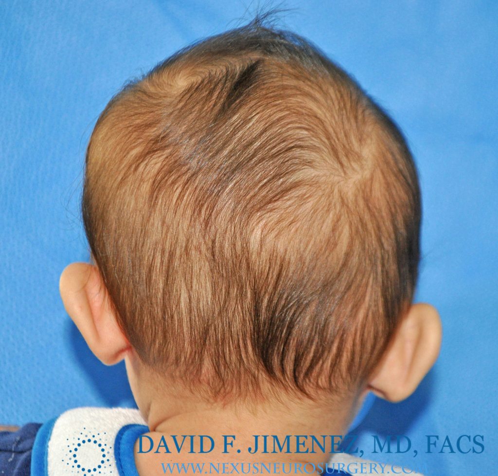 Lambdoid Synostosis Facts and Photos | Craniosynostosis