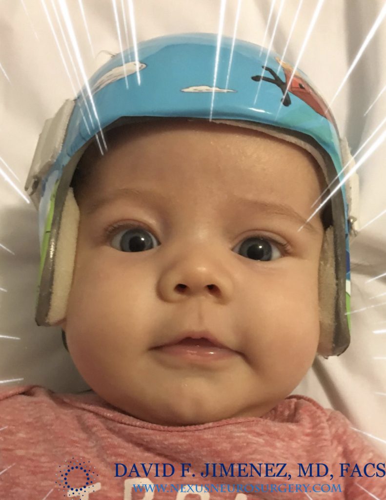 Helmets | Craniosynostosis