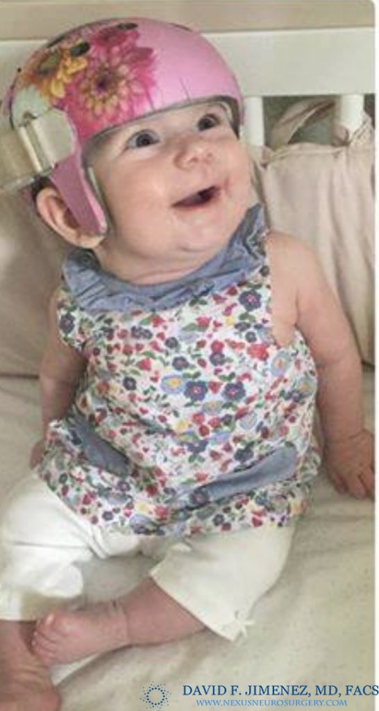 Helmets | Craniosynostosis