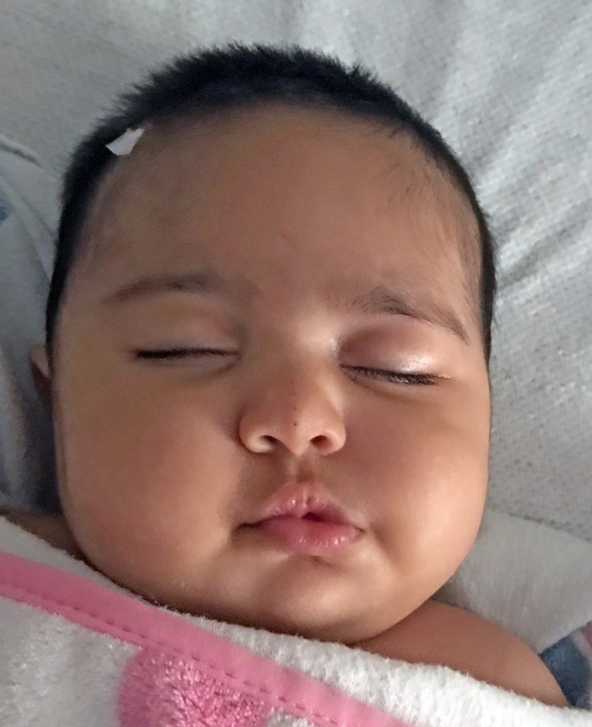 Coronal Synostosis Facts and Photos | Craniosynostosis