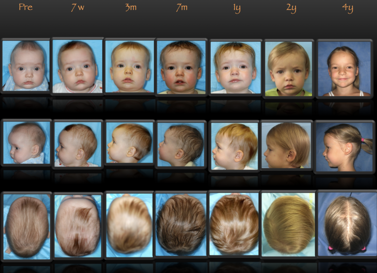 Sagittal Synostosis Facts and Photos | Craniosynostosis