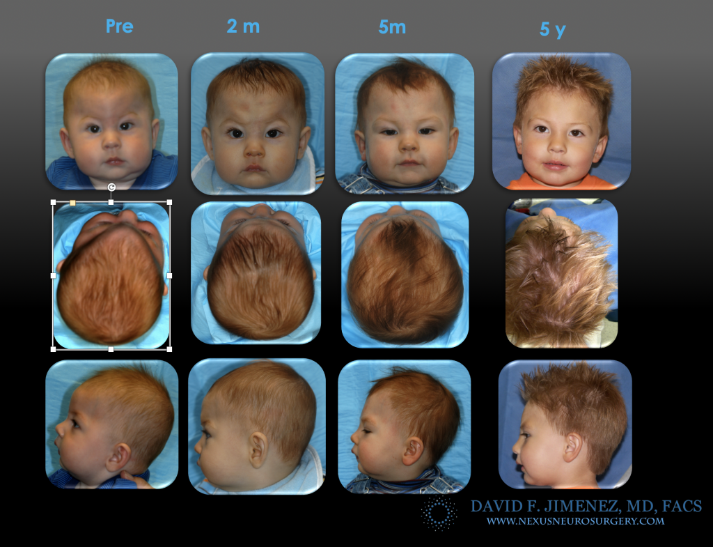 Metopic Synostosis Facts and Photos | Craniosynostosis