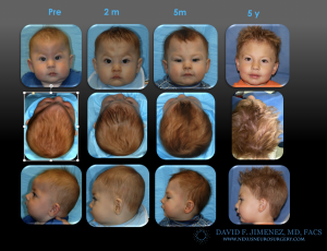 Metopic Synostosis Facts and Photos | Craniosynostosis